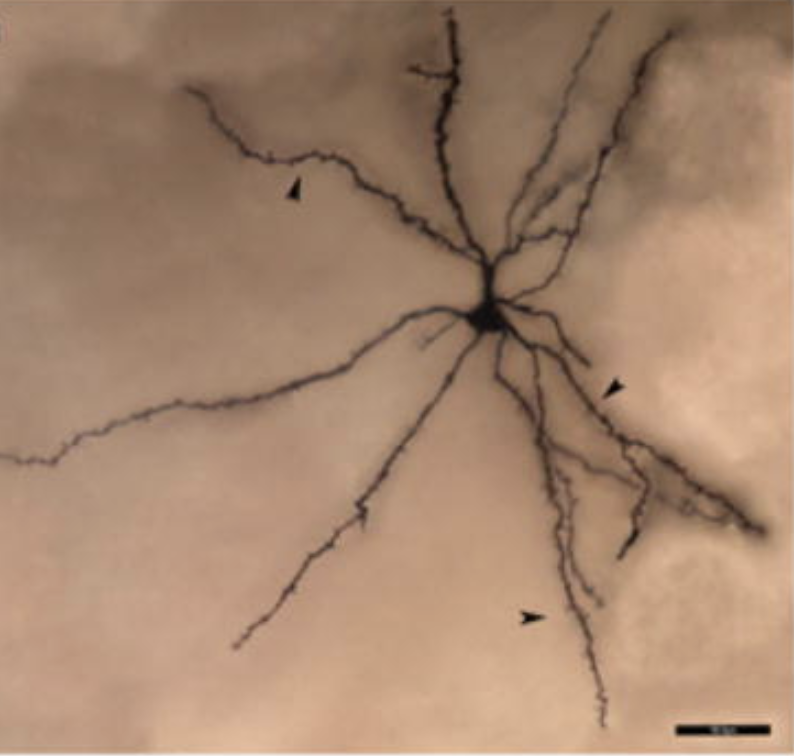 The amygdala shows microscopic changes in ASD - Autism BrainNet